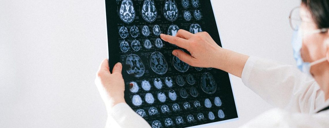 A Comprehensive Exploration of Post-Stroke Depression and Its ...